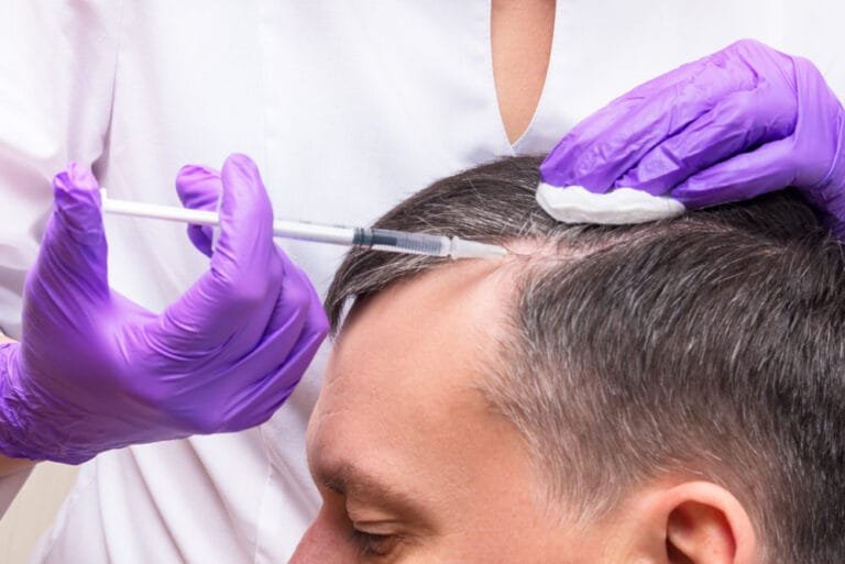 PRP Treatment for Hair Side Effects, Benefits, and What to Expect ...