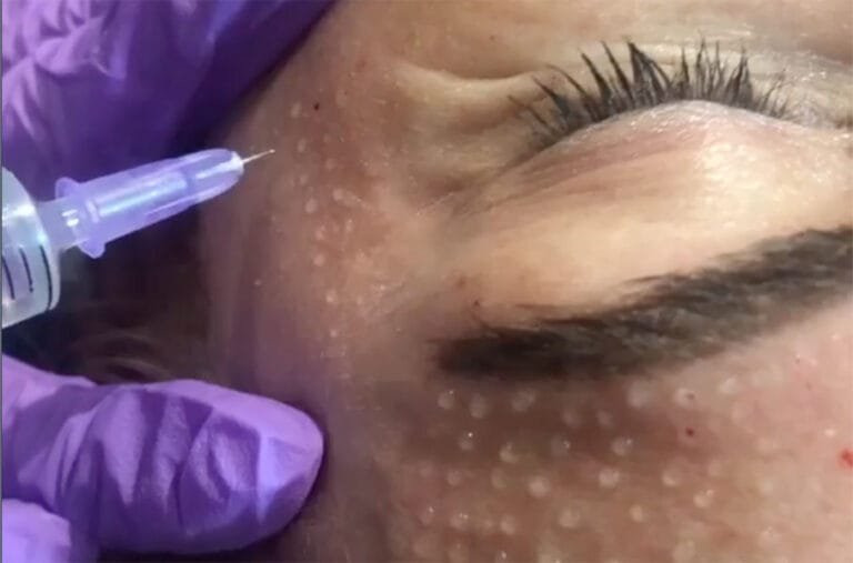 What is Mesotherapy? A Complete Beginner's Guide - Collective ...